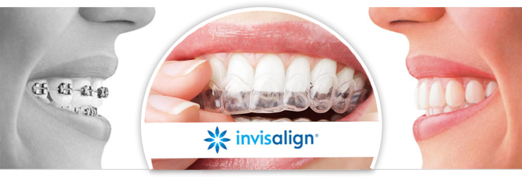 Stratford Invisalign treatment | Free Consultations | E15 Invisalign ...